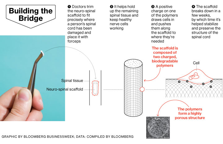 Early Promise for Neuro-Spinal Scaffold, a New Paralysis Treatment ...