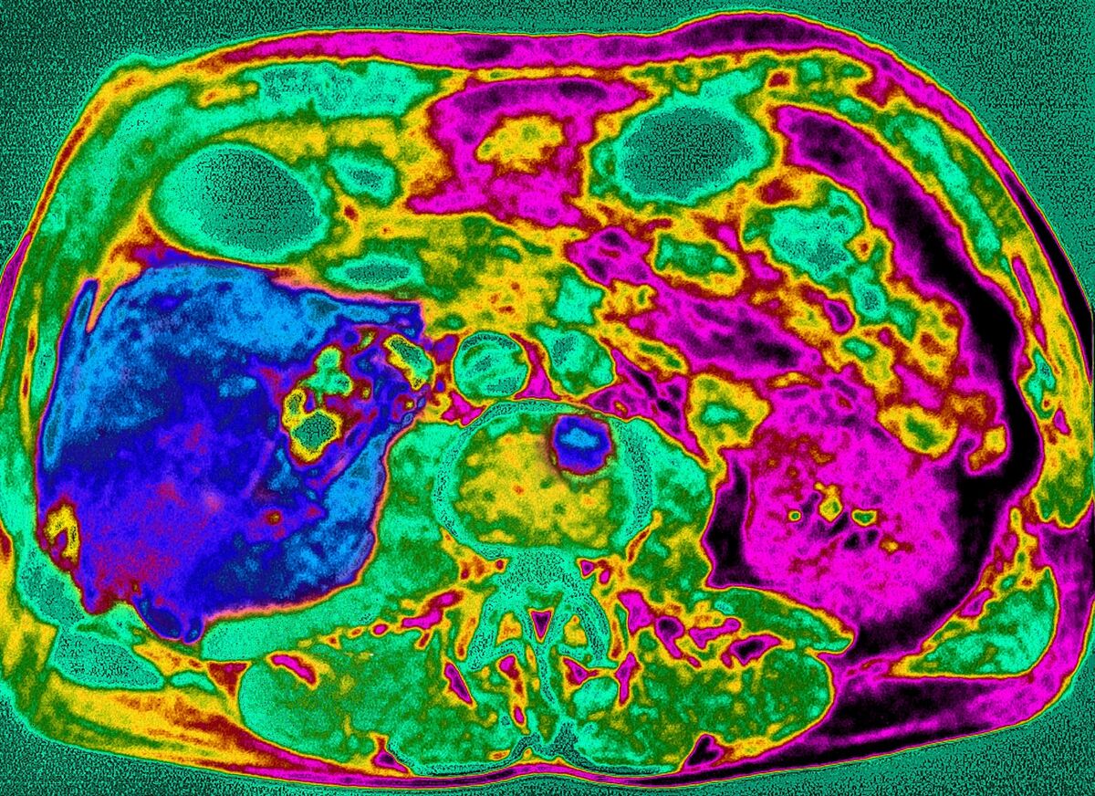 Astra, Merck Drugs Set to Shake Up Liver Cancer Treatment - Bloomberg