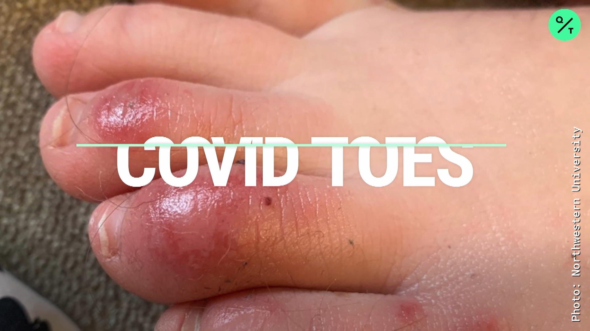 Watch Covid Toes a New Symptom of Coronavirus - Bloomberg