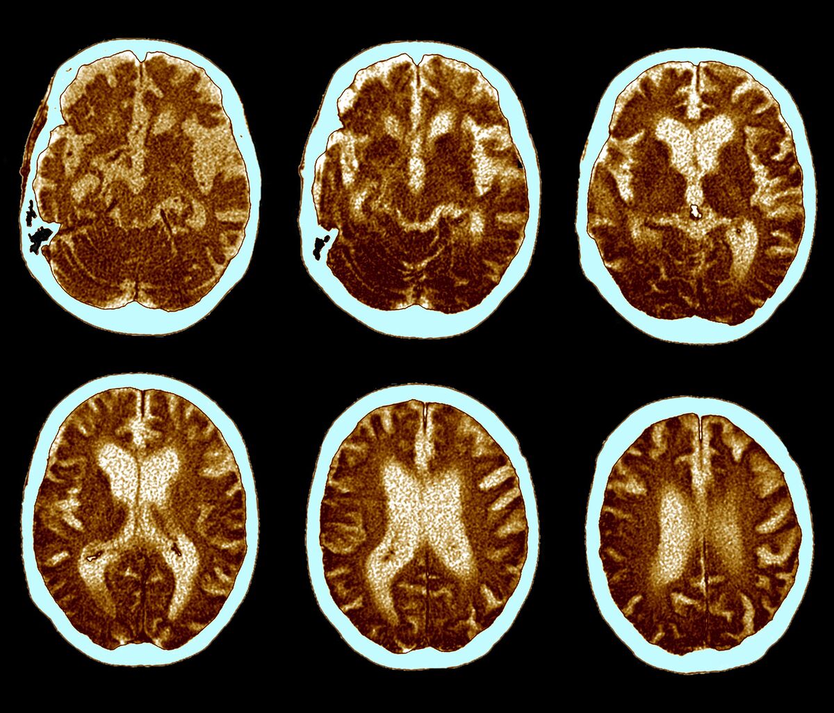 Merck Stops Alzheimer s Study After No Chance Of Benefit Bloomberg merck-stops-alzheimer-s-study-after-no-chance-of-benefit-bloomberg